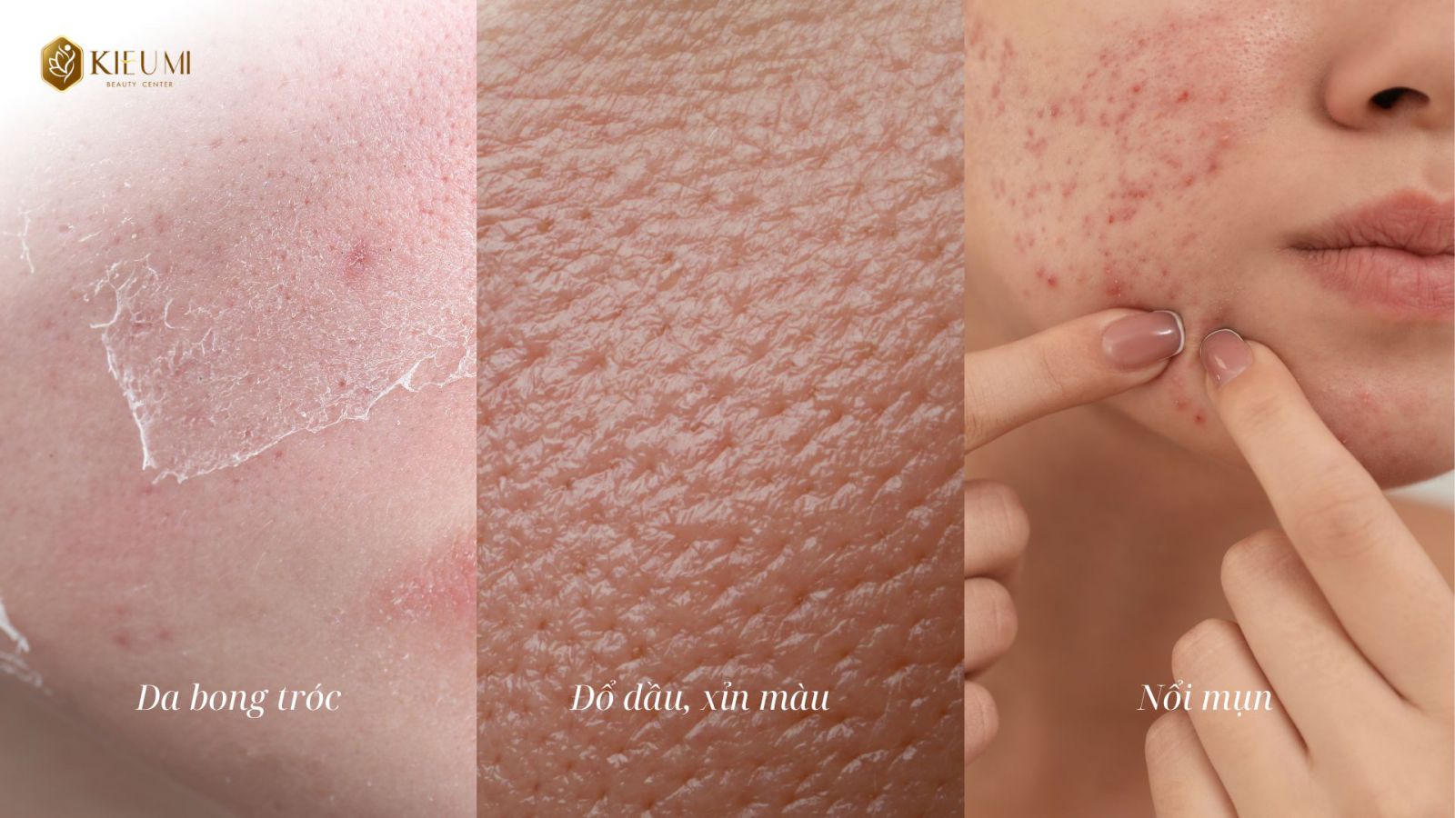 3 tình trạng da thường gặp sau Tết và cách khắc phục